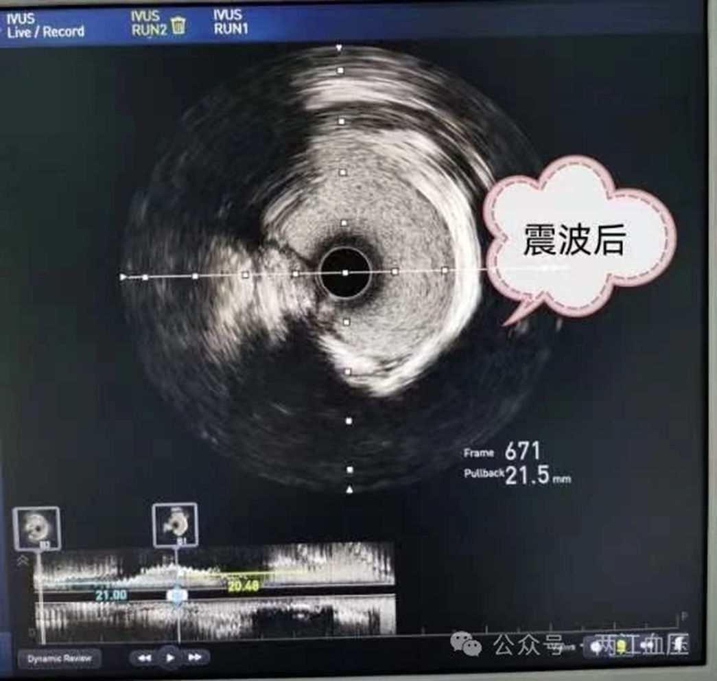价格便宜近四成 重庆首例国产冠脉冲击波球囊应用临床守护生命禁区 华龙网